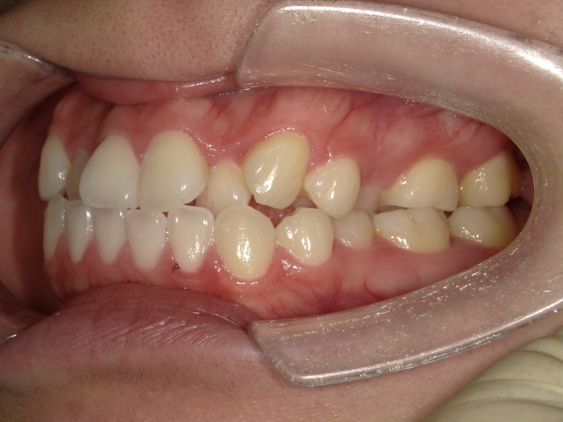 前歯のガタツキと噛み合わせを改善 ｜島歯科・矯正歯科